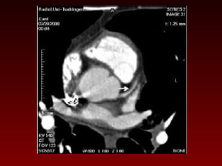 121 non invasive imaging of coronary arteries | PPT
