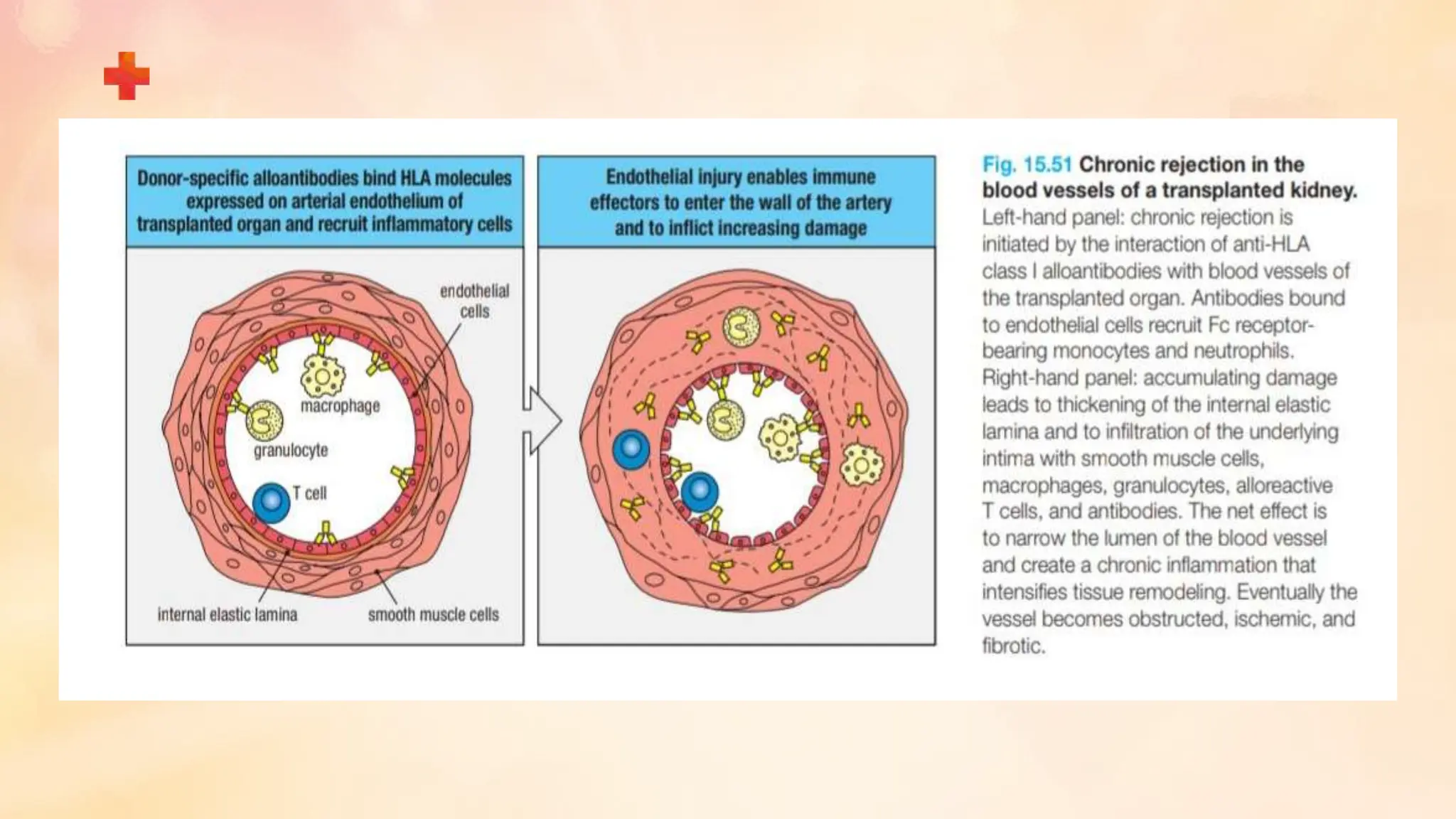 transplantation_and_rejection , classification of graft , rejection ...