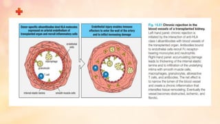 transplantation_and_rejection , classification of graft , rejection ...
