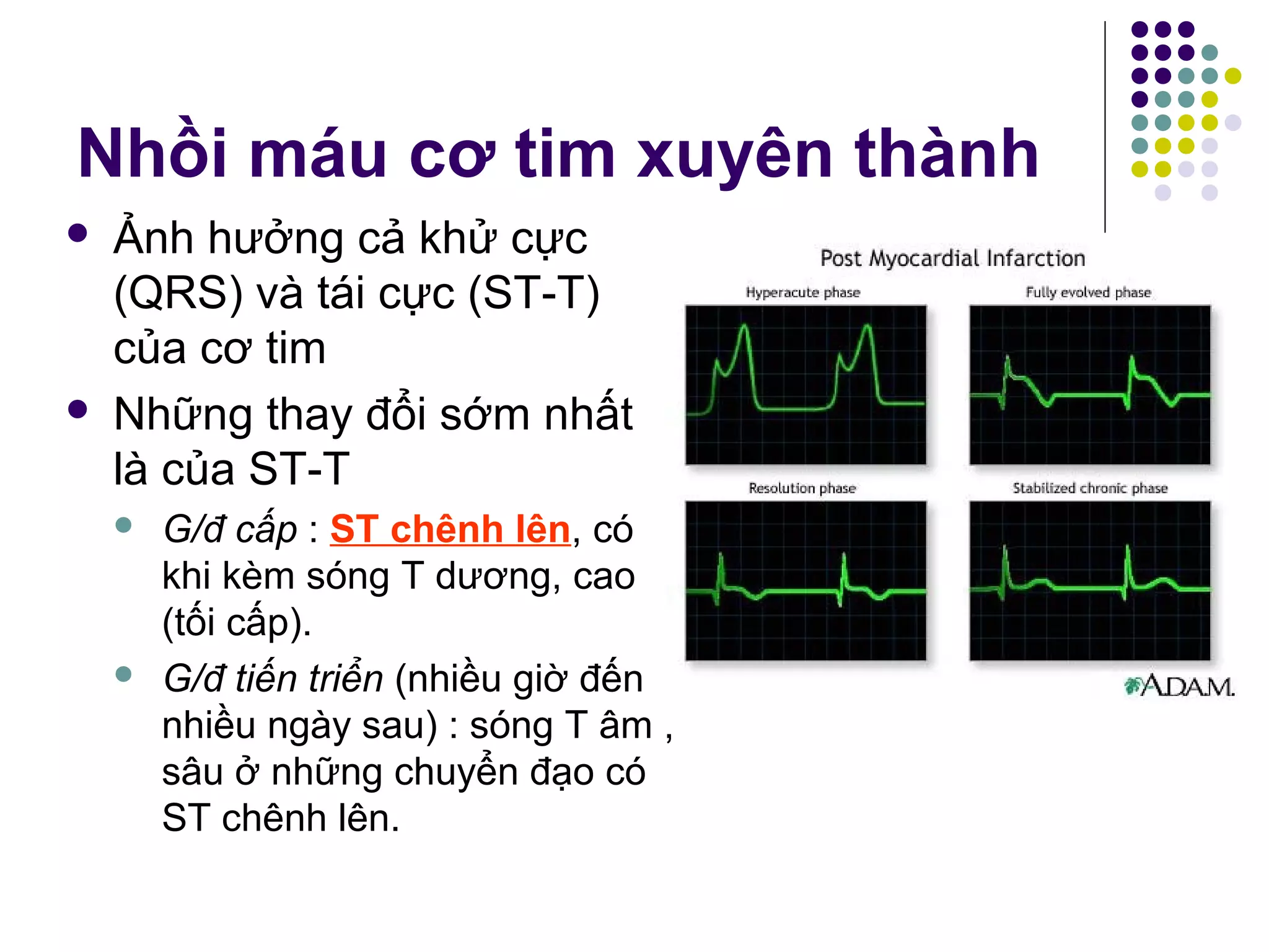 ECG TRONG NHỒI MÁU CƠ TIM | PPT