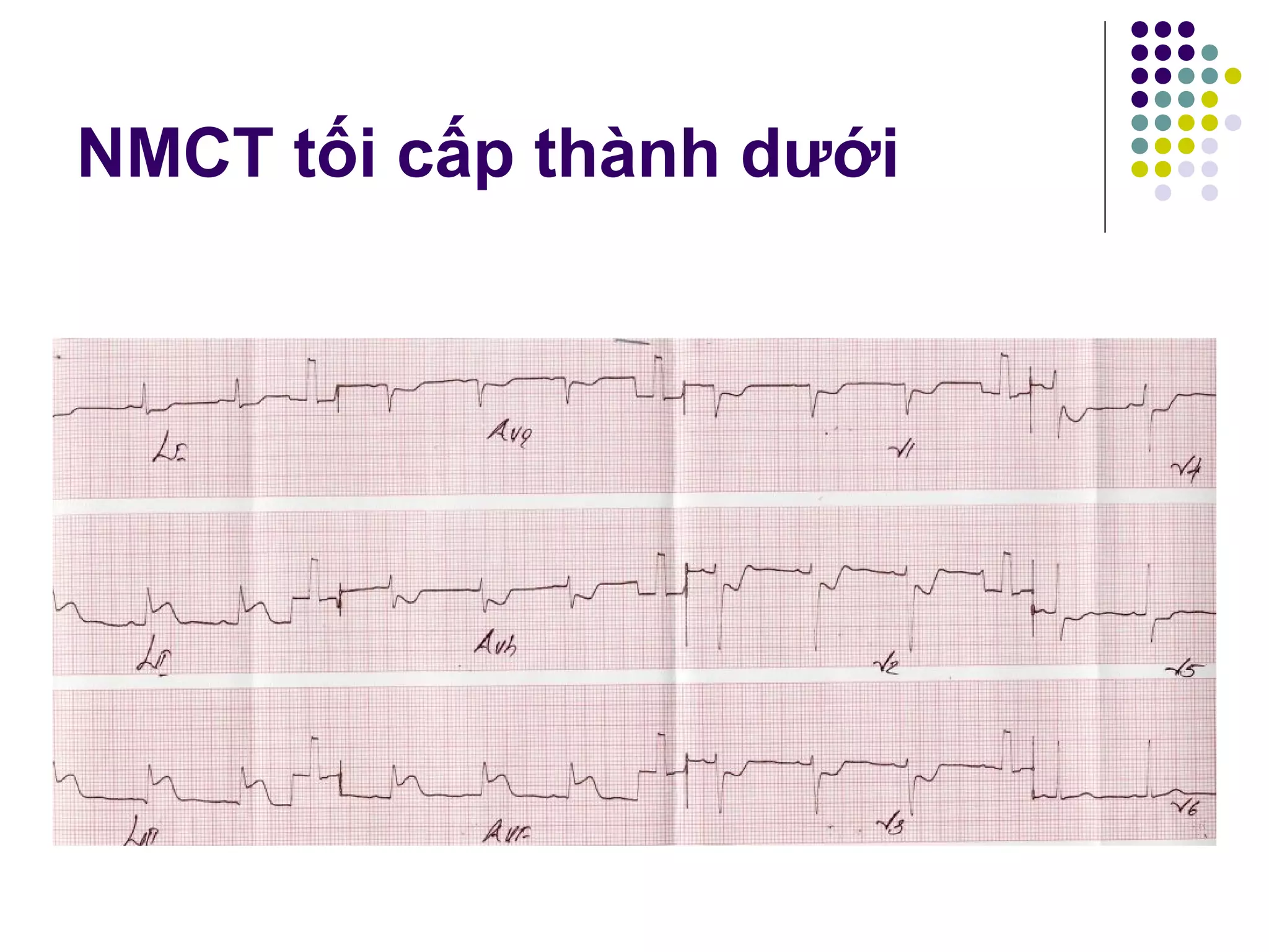 ECG TRONG NHỒI MÁU CƠ TIM | PPT