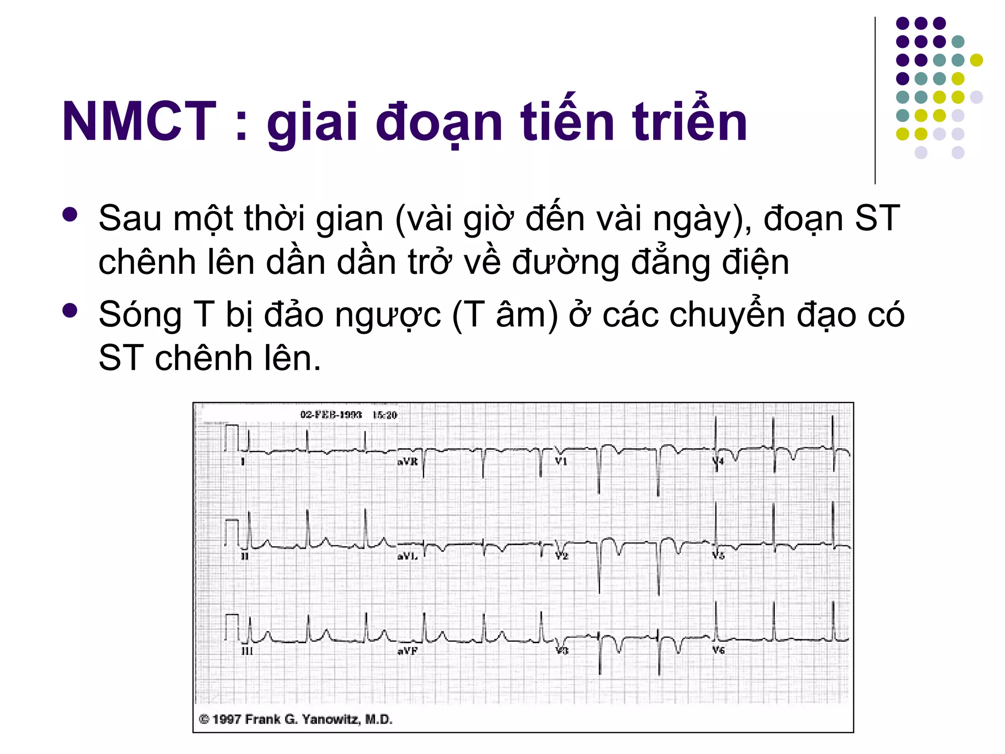 ECG TRONG NHỒI MÁU CƠ TIM | PPT