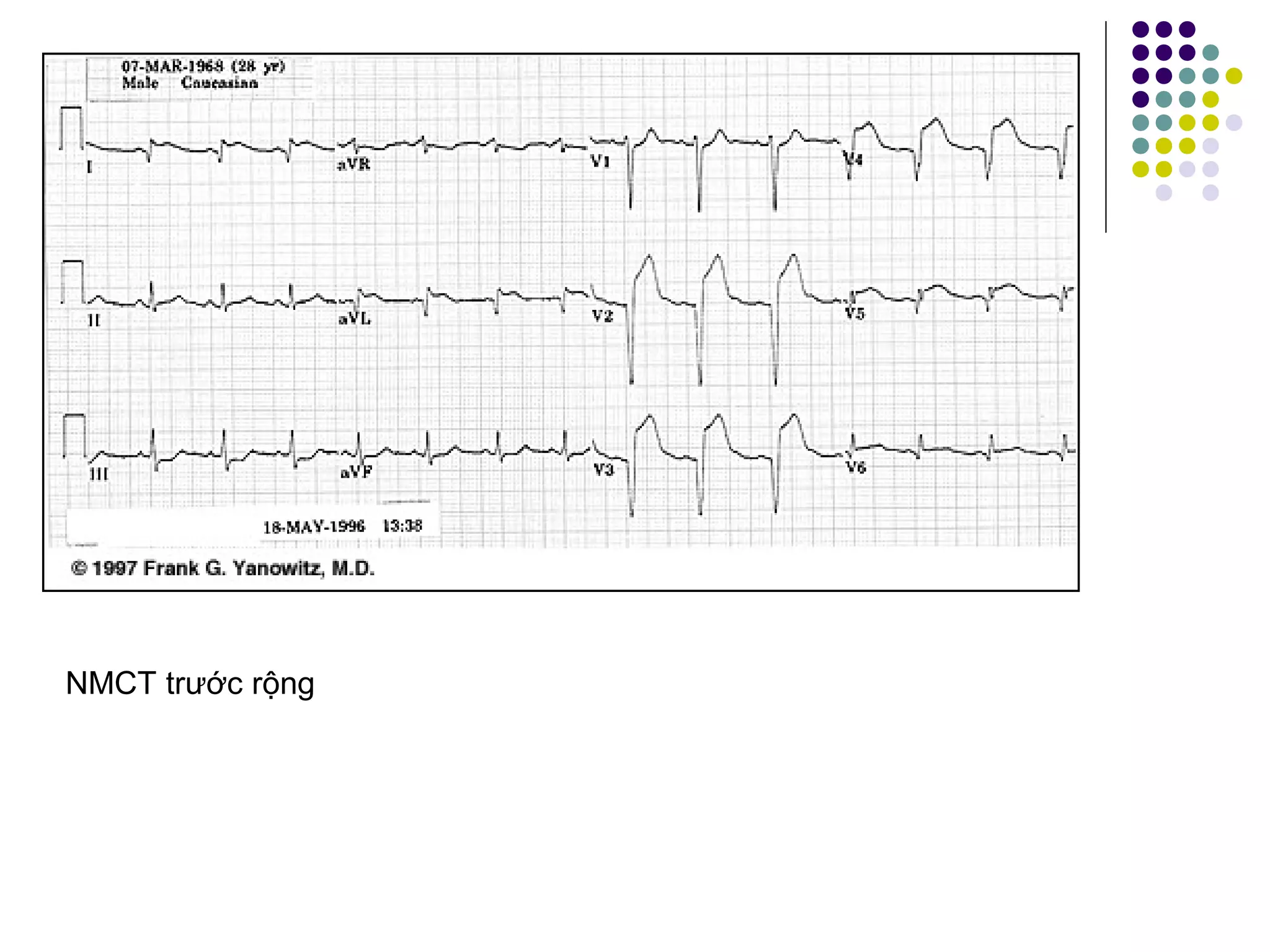 ECG TRONG NHỒI MÁU CƠ TIM | PPT