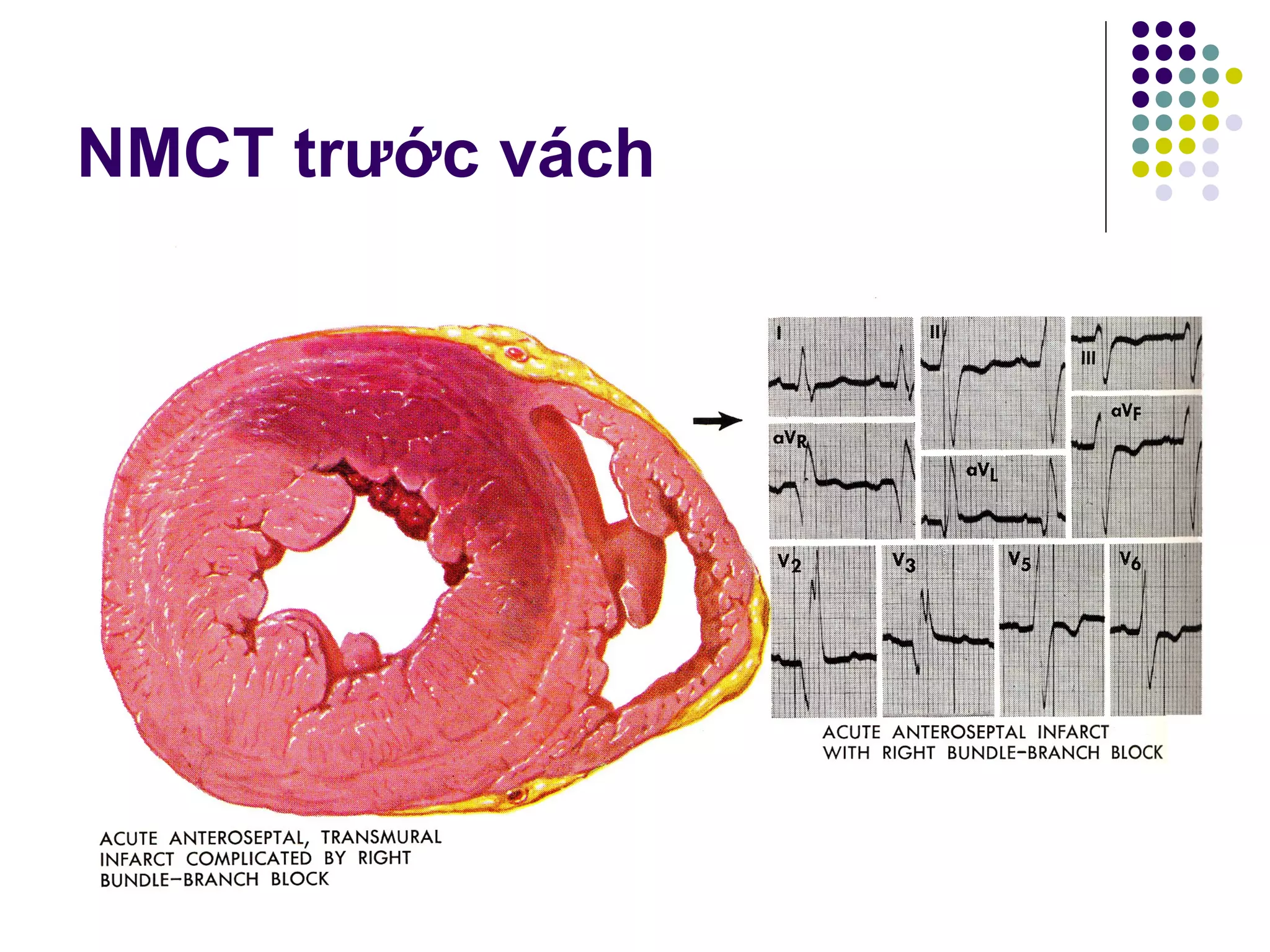 ECG TRONG NHỒI MÁU CƠ TIM | PPT