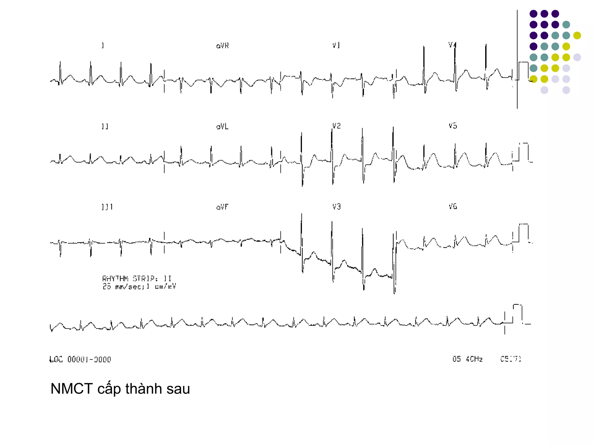 ECG TRONG NHỒI MÁU CƠ TIM | PPT