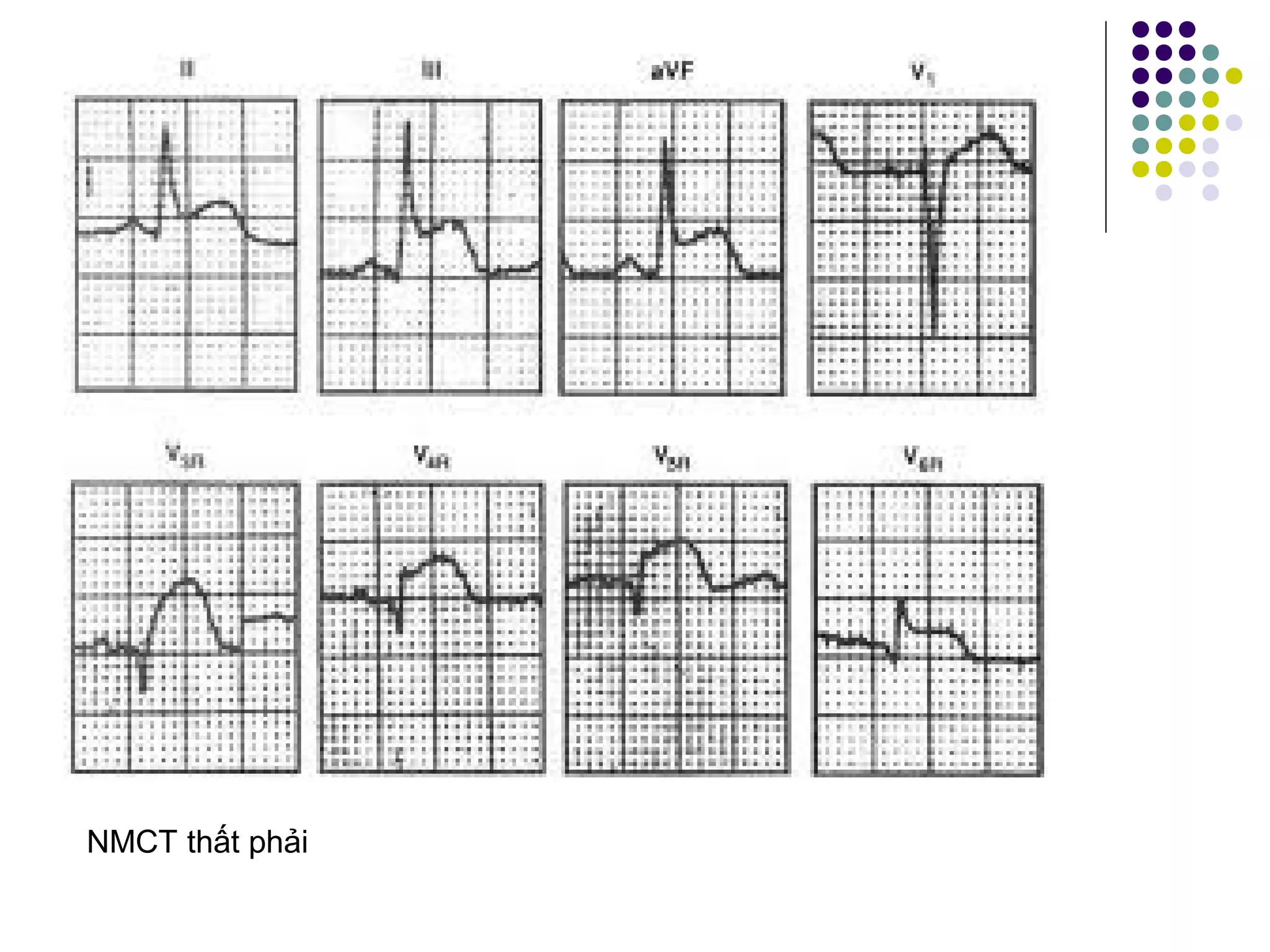 ECG TRONG NHỒI MÁU CƠ TIM | PPT