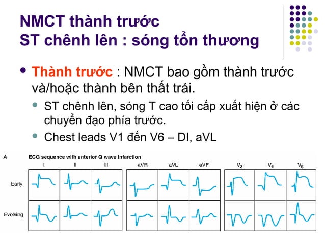 ECG TRONG NHỒI MÁU CƠ TIM | PPT