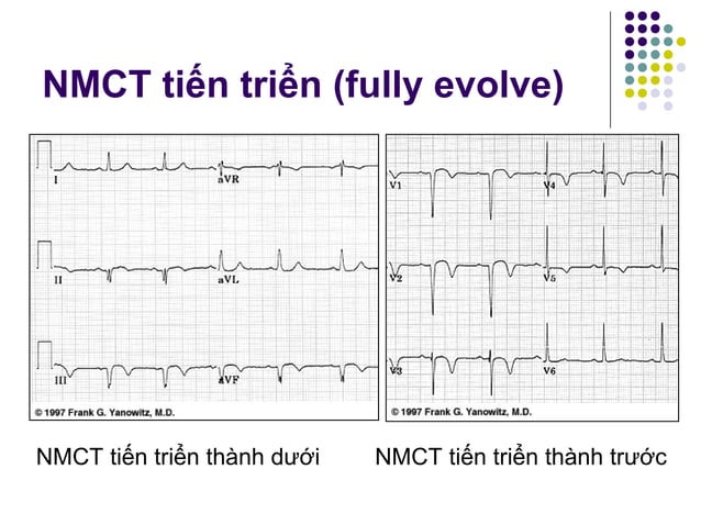 ECG TRONG NHỒI MÁU CƠ TIM | PPT