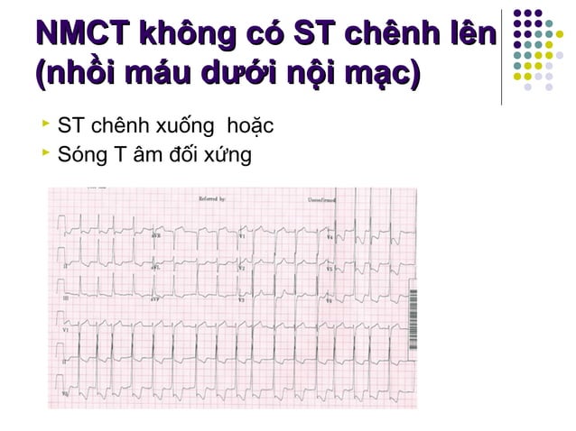 ECG TRONG NHỒI MÁU CƠ TIM | PPT