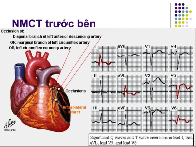 ECG TRONG NHỒI MÁU CƠ TIM | PPT