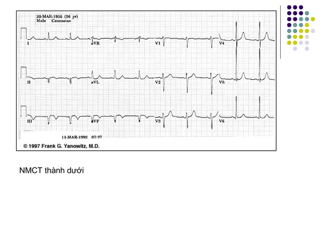 ECG TRONG NHỒI MÁU CƠ TIM | PPT