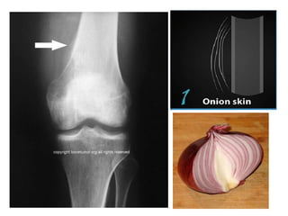 Ewing Sarcoma Onion Skin