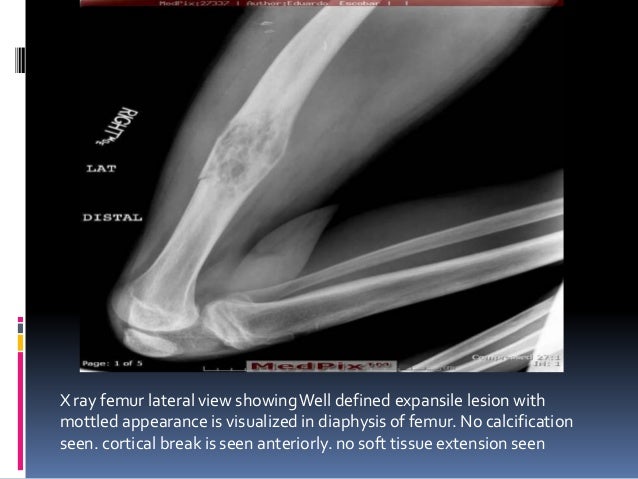 Ewing’s sarcoma & Simple bone cyst