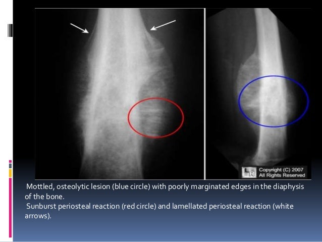 Ewing’s sarcoma & Simple bone cyst