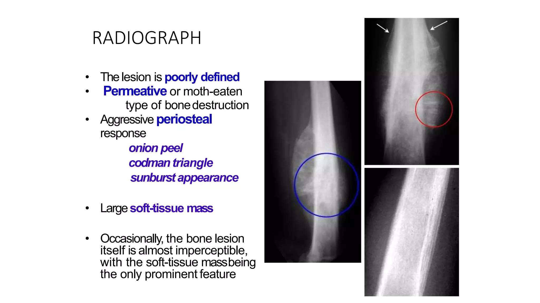 Ewing's sarcoma | PPTX