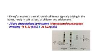 Ewing's sarcoma | PPTX