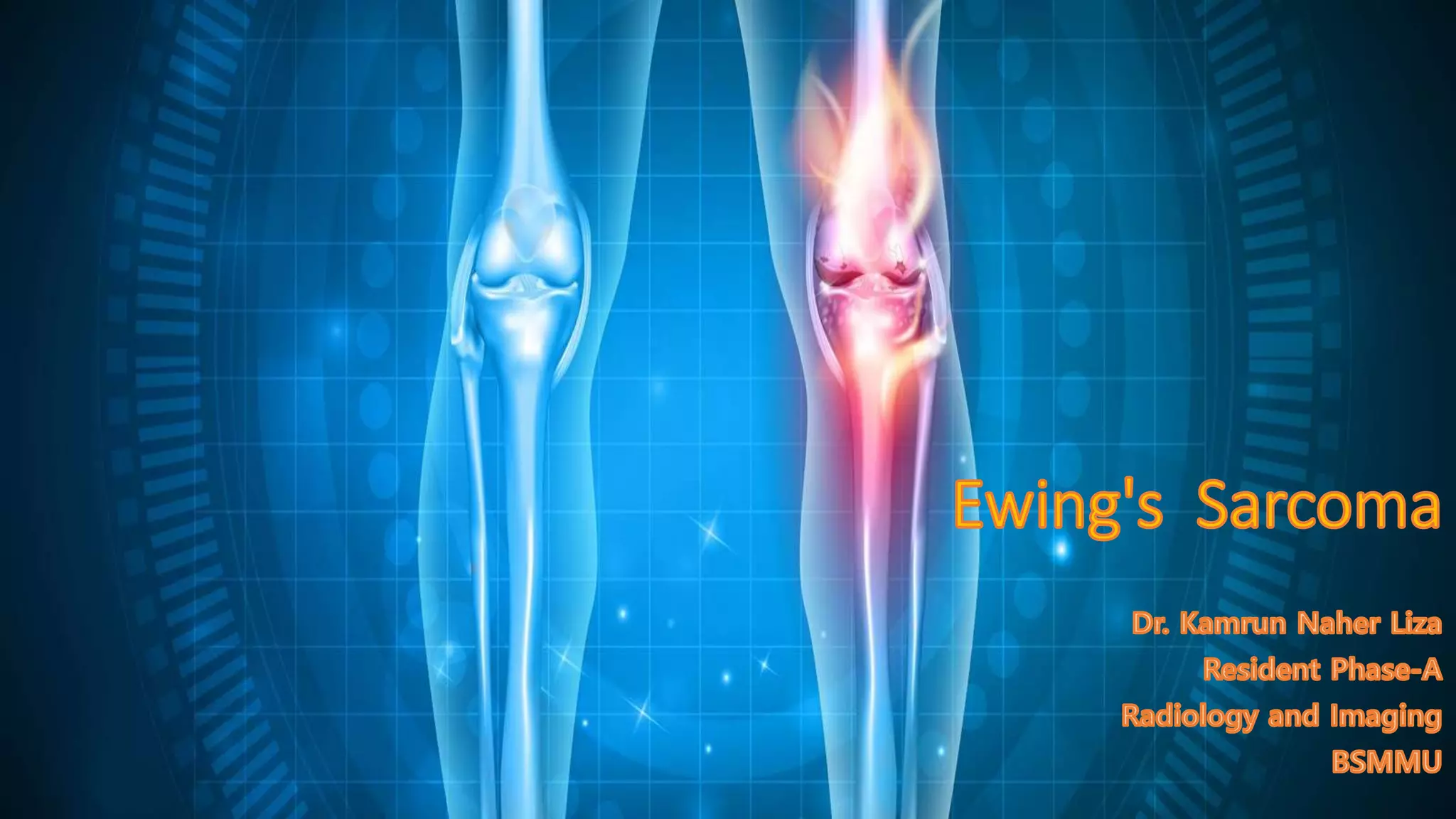 Ewing's Sarcoma.pptx