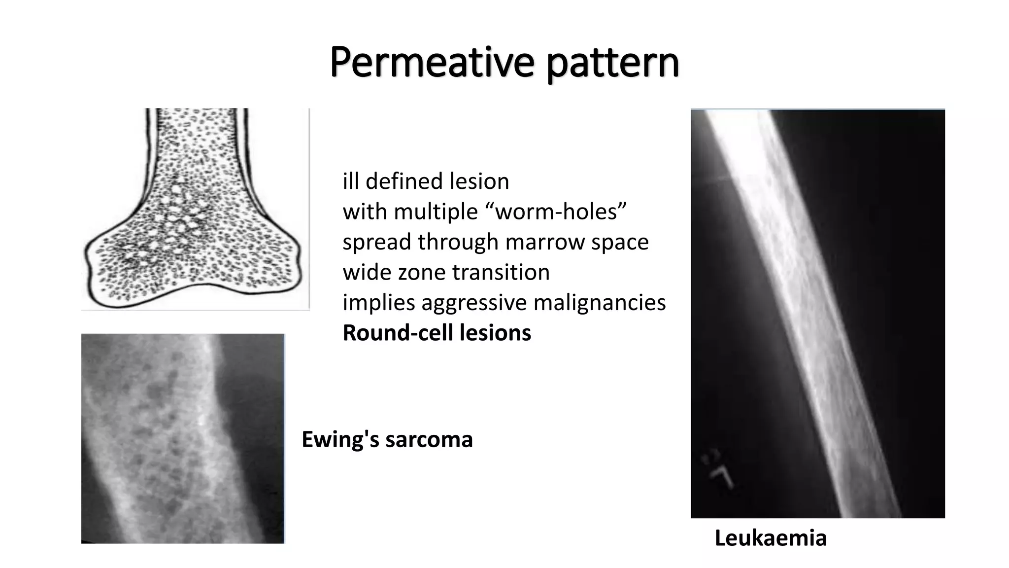 Ewing's Sarcoma.pptx