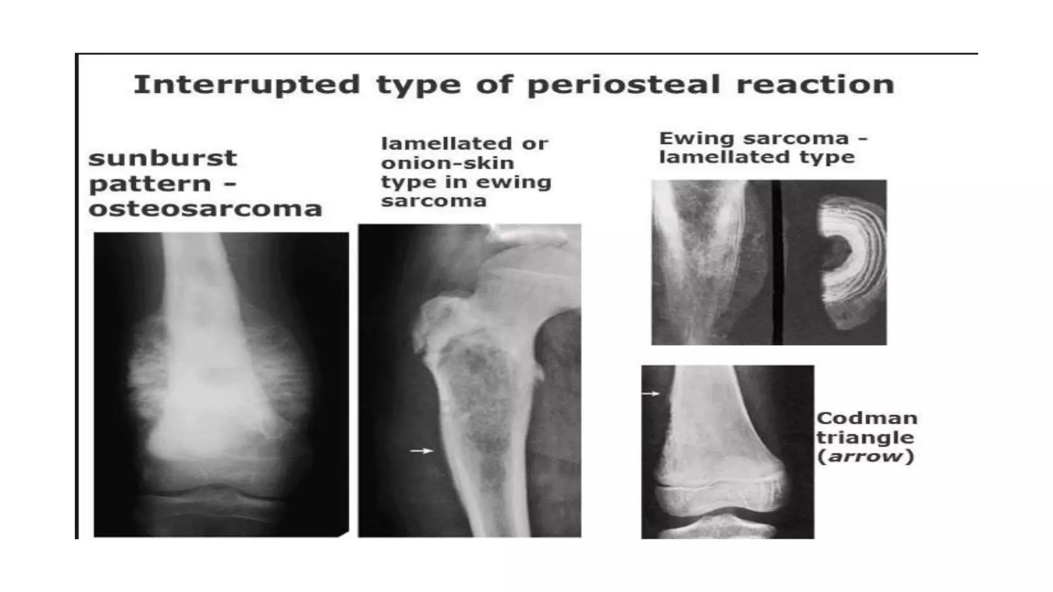 Ewing's Sarcoma.pptx