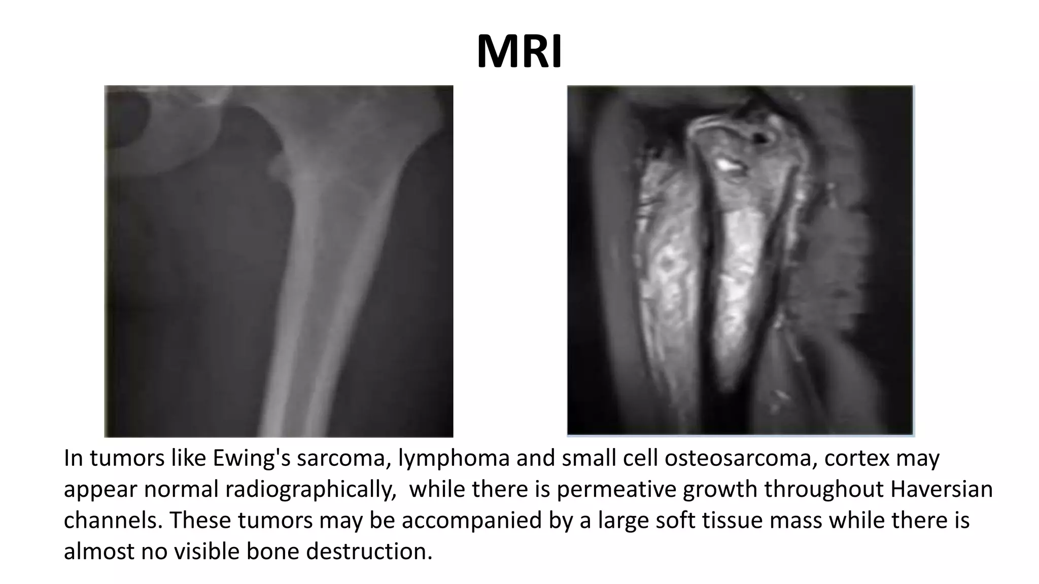 Ewing's Sarcoma.pptx