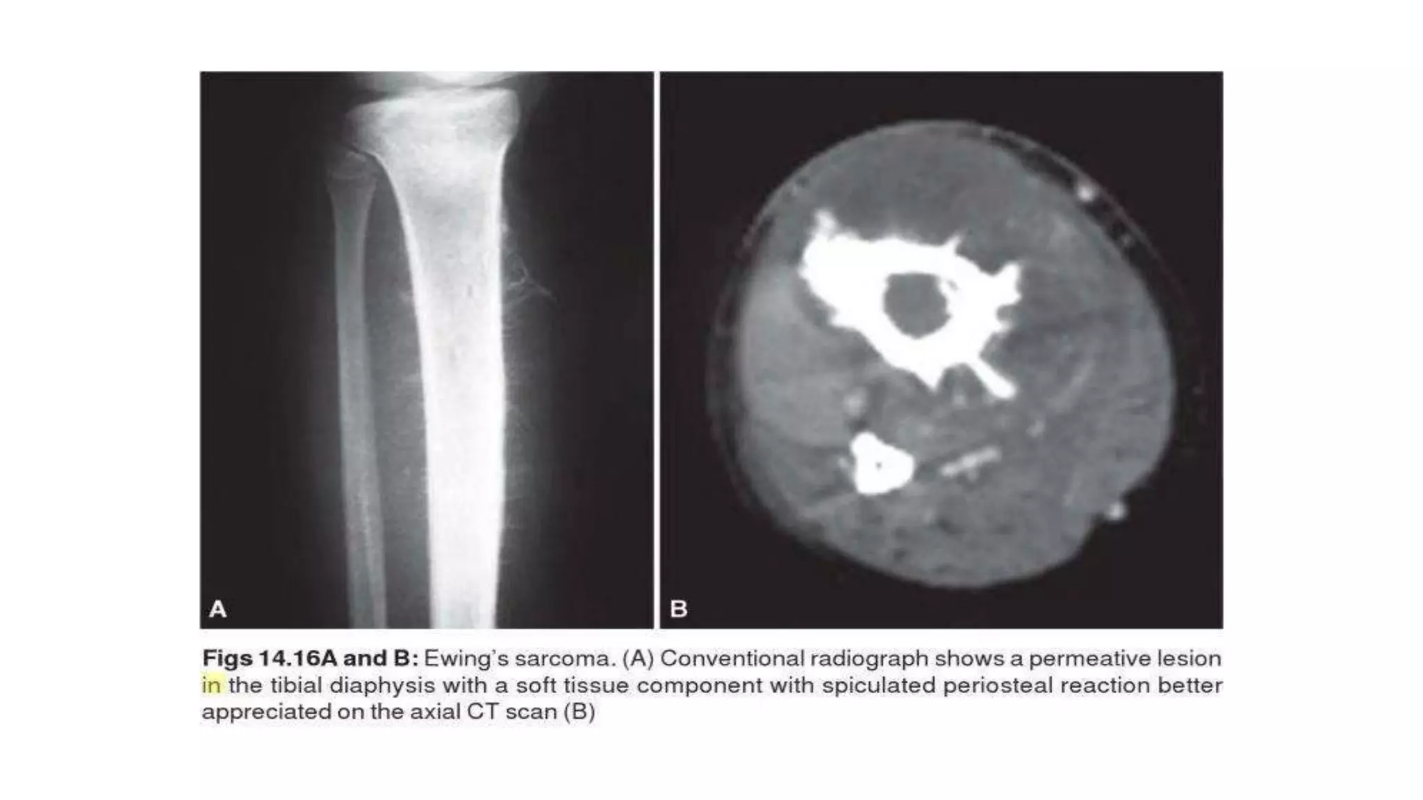 Ewing's Sarcoma.pptx