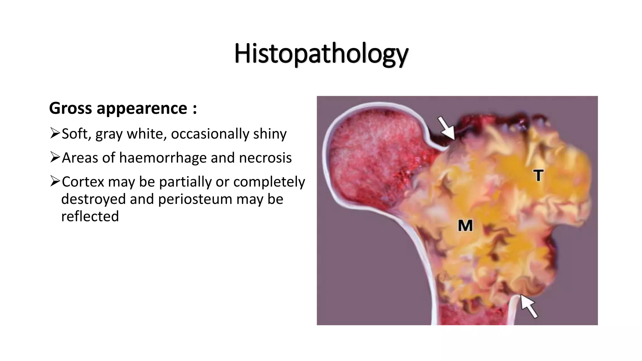 Ewing's Sarcoma.pptx