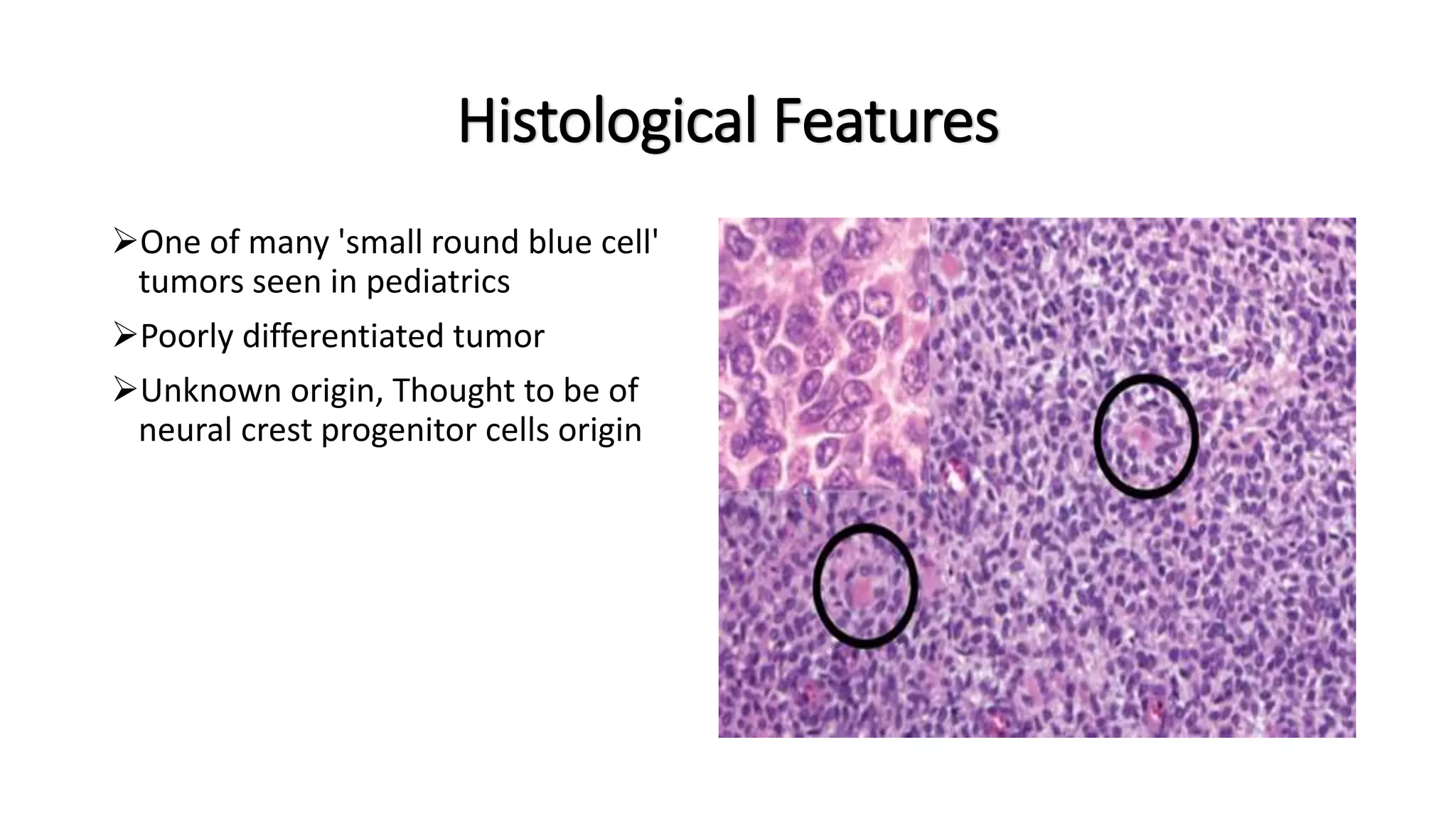 Ewing's Sarcoma.pptx