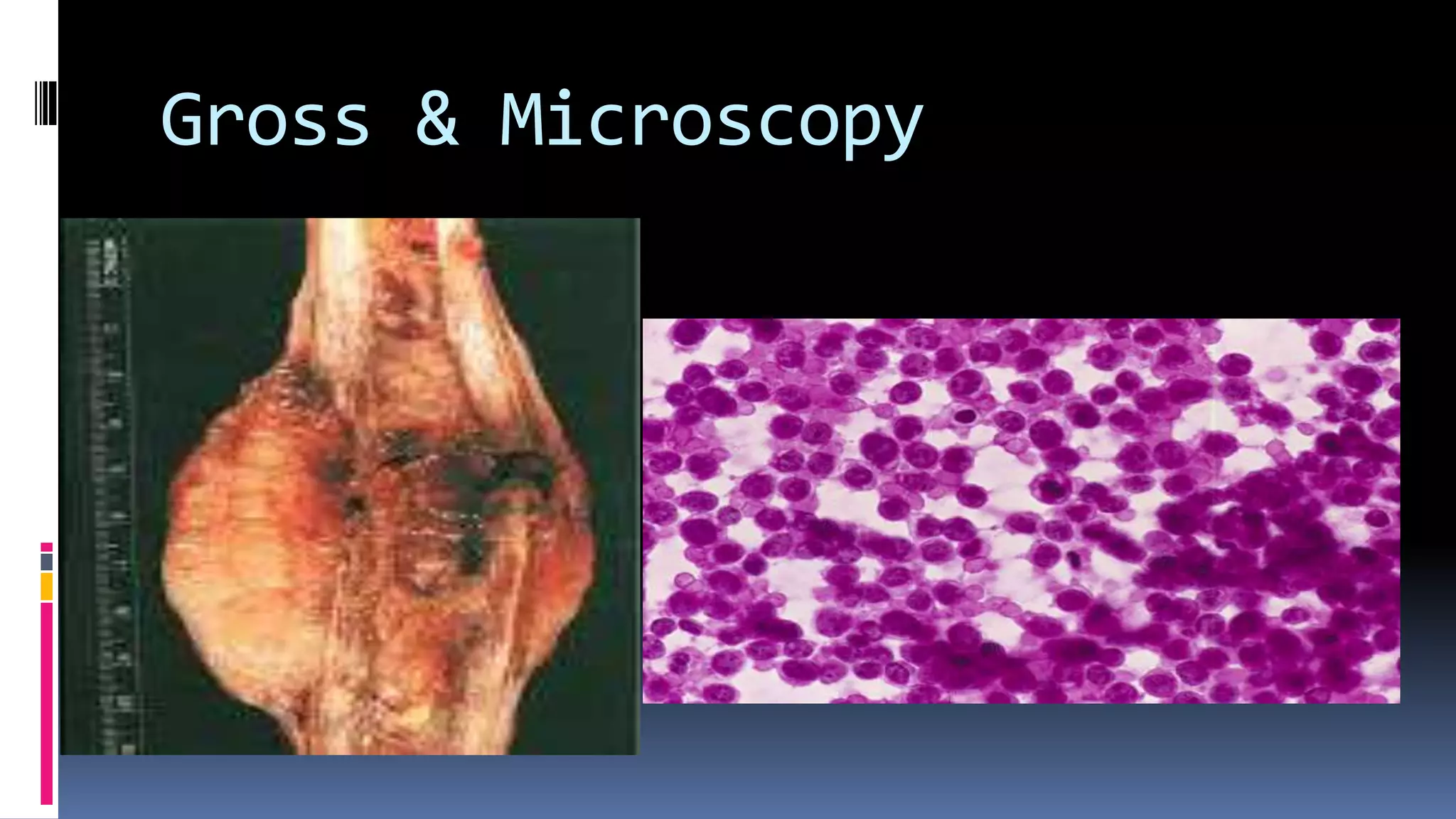 Ewing’s sarcoma | PPTX