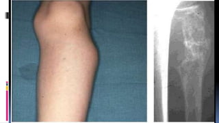 Ewing’s sarcoma | PPT