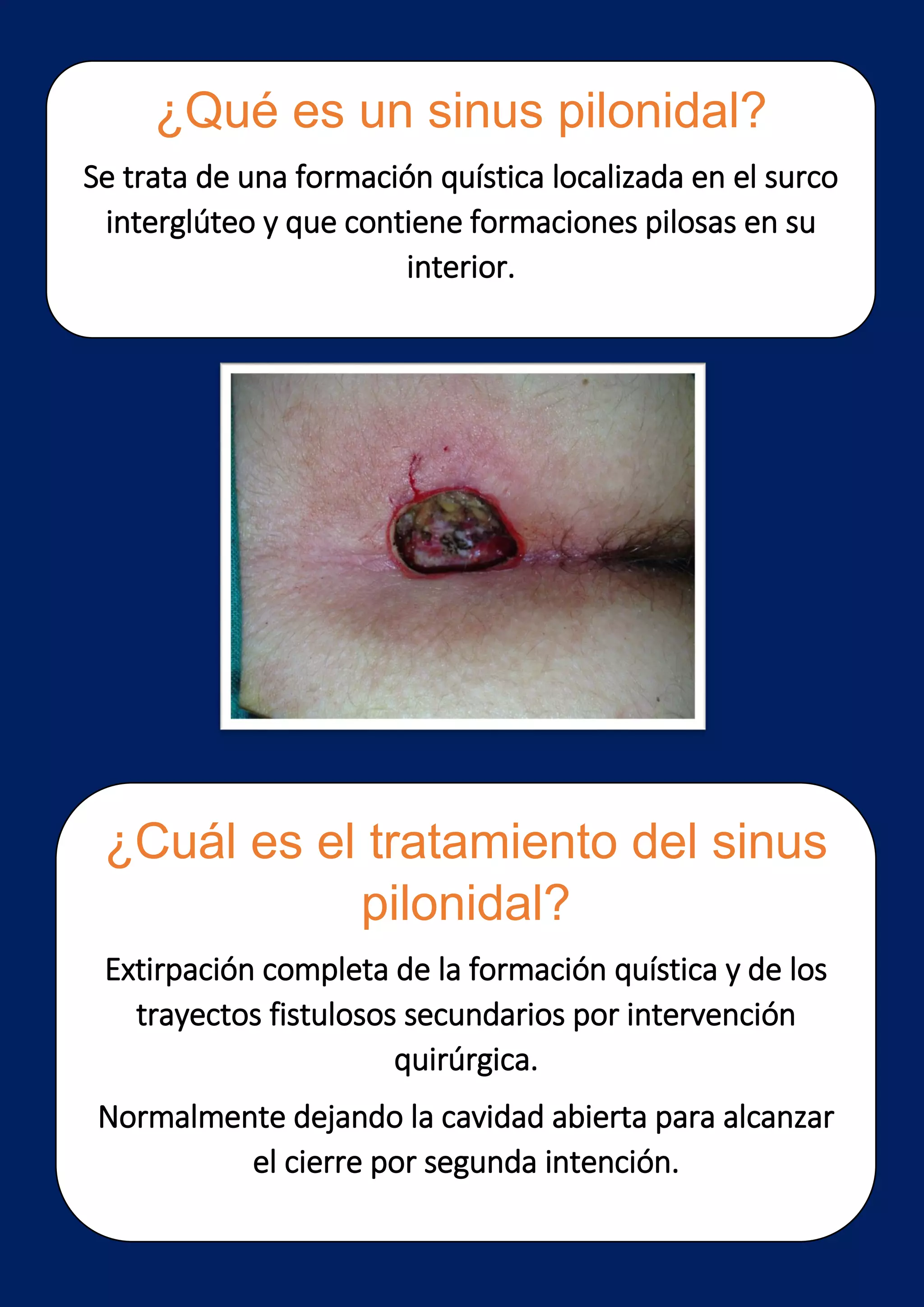 EWMA 2014 - EP382 STANDARDIZED CURE FOR PILONIDAL SINUS | PDF