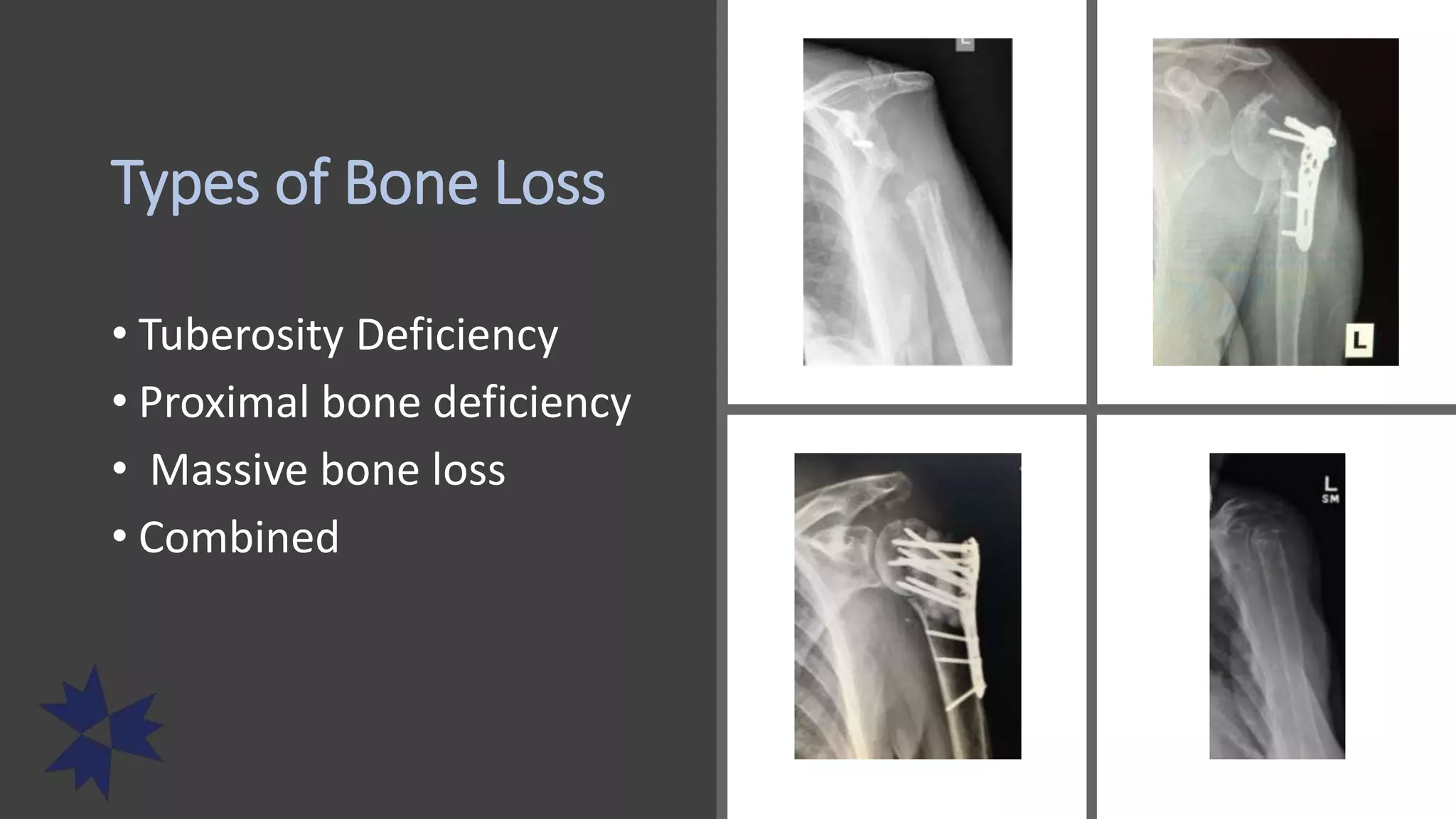 Exactech Humeral Reconstruction Prosthesis Overview | PPT