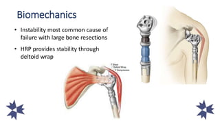 Exactech Humeral Reconstruction Prosthesis Overview | PPT
