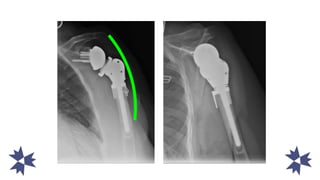 Exactech Humeral Reconstruction Prosthesis Overview | PPT