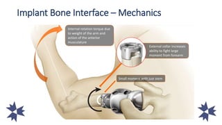 Exactech Humeral Reconstruction Prosthesis Overview | PPT