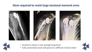 Exactech Humeral Reconstruction Prosthesis Overview | PPT