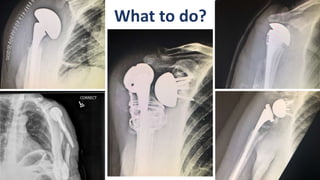 Exactech Humeral Reconstruction Prosthesis Overview | PPT