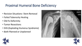 Exactech Humeral Reconstruction Prosthesis Overview | PPT