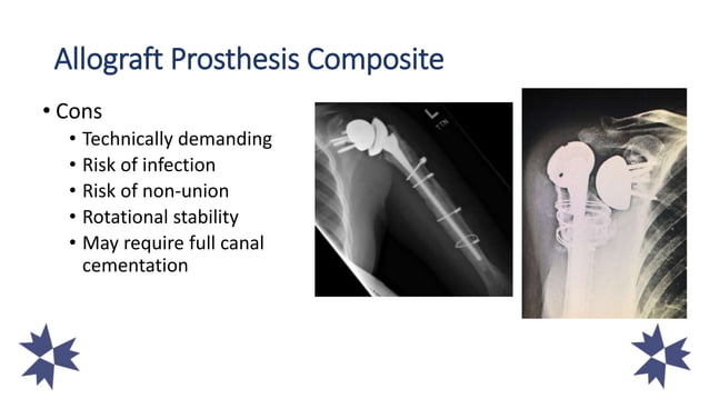 Exactech Humeral Reconstruction Prosthesis Overview | PPT