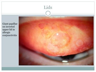 EXAMINATION OF ANTERIOR SEGMENT OF EYE | PPTX