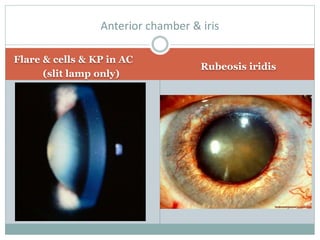 EXAMINATION OF ANTERIOR SEGMENT OF EYE | PPTX