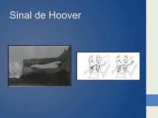 Exame neurológico coluna lombar | PPT