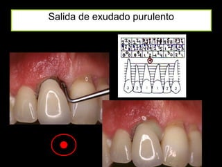 Examen clinico periodontal | PPT