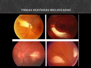 Examen de fondo de ojo | PPTX