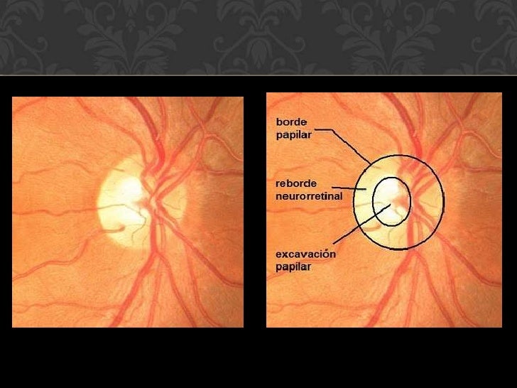 Examen de fondo de ojo