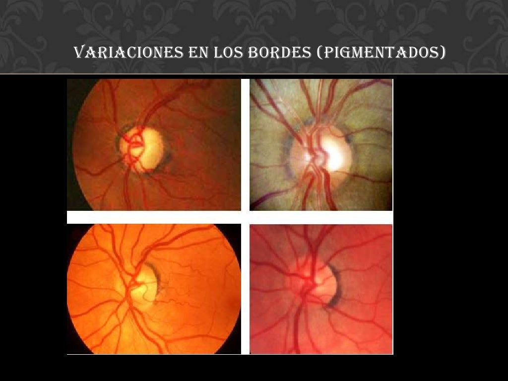 Examen de fondo de ojo