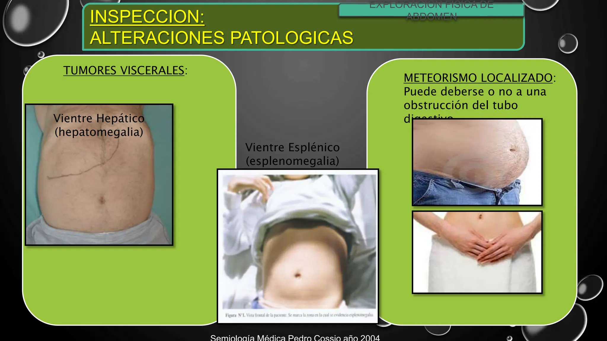 EXAMEN FISICO DE ABDOMEN semiologia de abdomen | PPTX