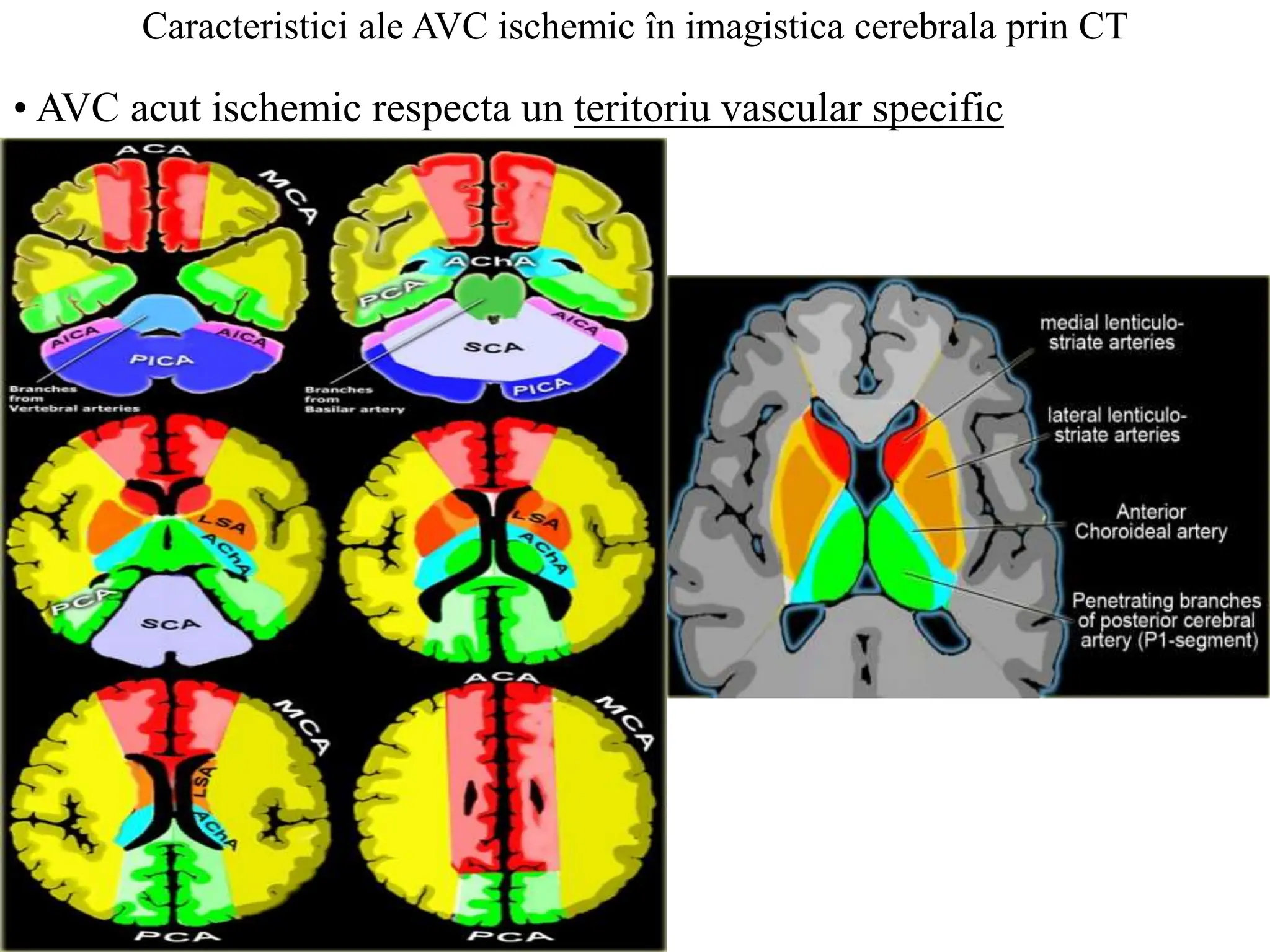 Examinarea CT cerebrala-AVC ischemic.pptx