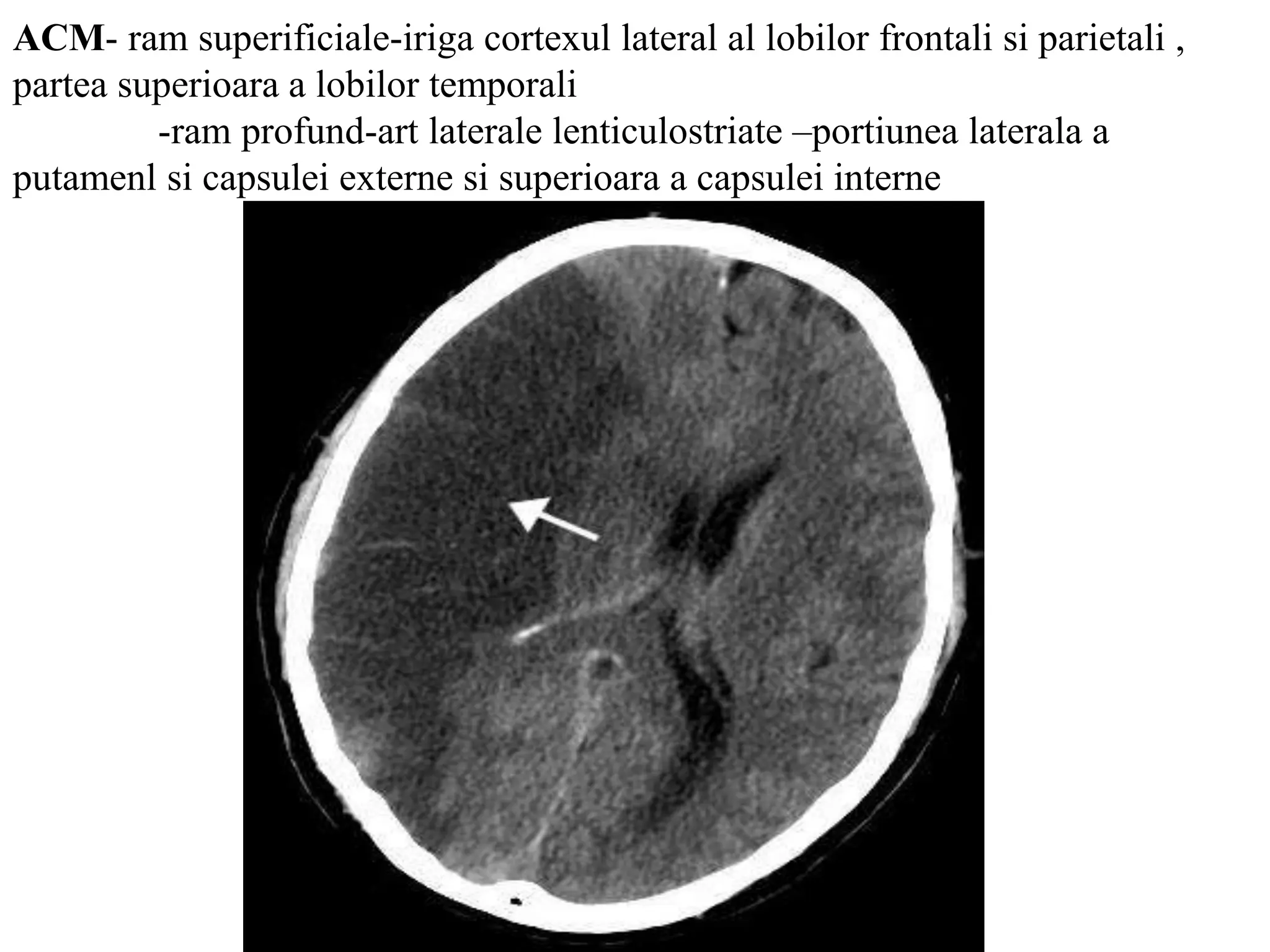 Examinarea CT cerebrala-AVC ischemic.pptx