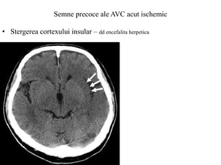 Examinarea CT cerebrala-AVC ischemic.pptx