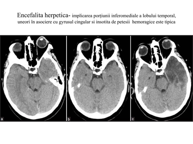 Examinarea CT cerebrala-AVC ischemic.pptx
